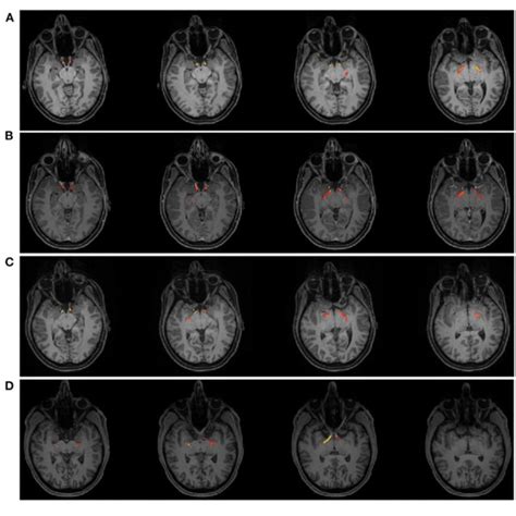 Tractography Results Of The Optic Tract For Patient Aj At Each Time