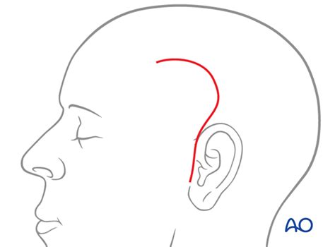 Gap Arthroplasty For Mandibular Hypomobilityankylosis
