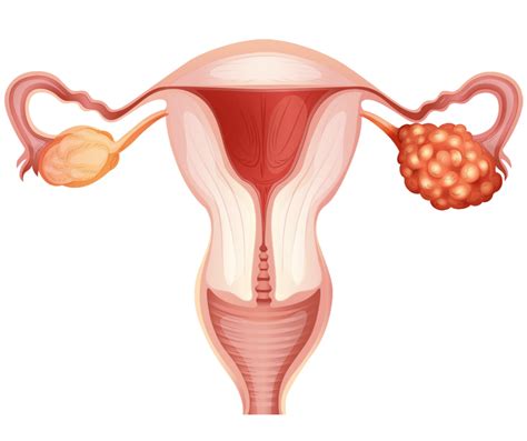 Các giai đoạn của ung thư buồng trứng BvNTP