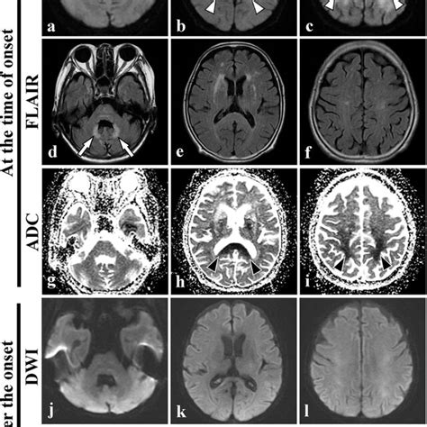 Brain Magnetic Resonance Imaging Mri Of The Present Patient With
