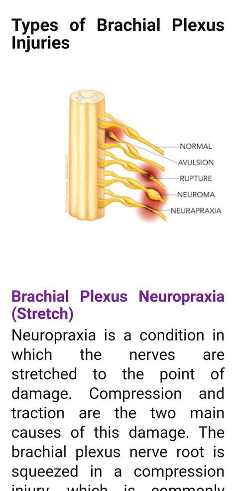Types Of Brachial Plexus Injuries How Many Types Of Brachial Plexus Injuries Plexus Products