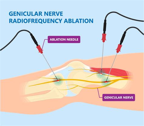 Genicular Nerve Radio Frequency Ablation Procedure And Recovery