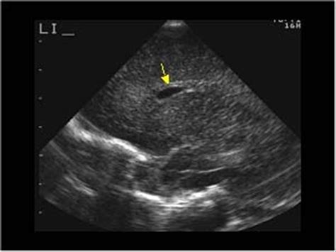 Pediatrics Neonatal Brain And Spine Case Hemorrhage And Periventricular Cysts