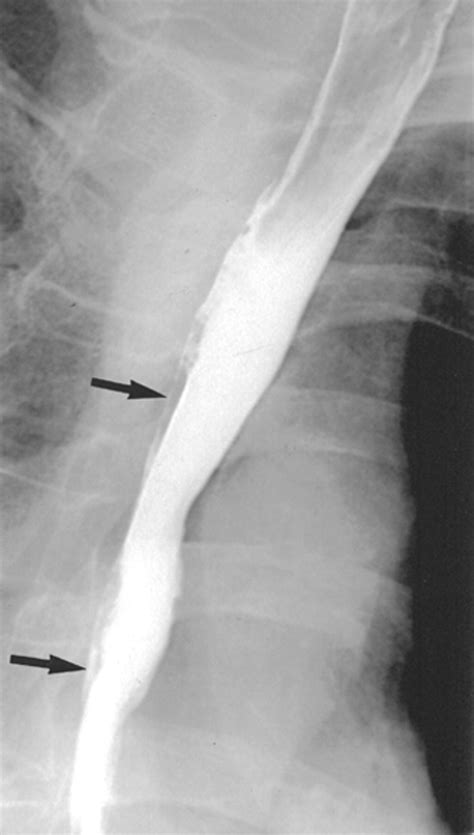 Acute Diffuse Phlegmonous Esophagogastritis Radiologic Diagnosis Ajr