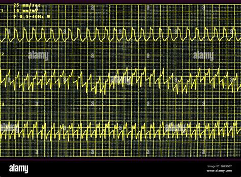 Atrial Fibrillation What Are The Different Types 50 Off