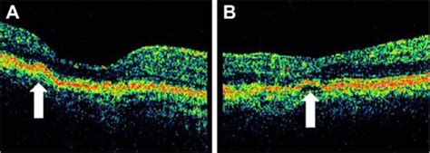 Stratus Optical Coherence Tomography Image Notes A And B Comparison