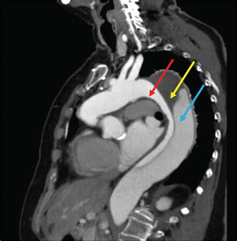 Acute Aortic Dissection The Lancet