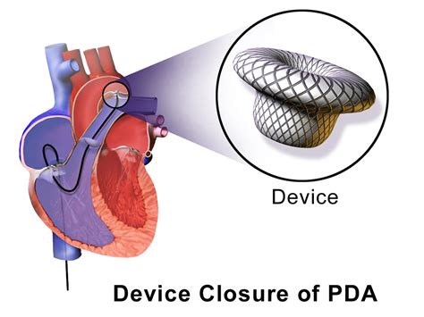 How Is Patent Ductus Arteriosus Treated Storymd