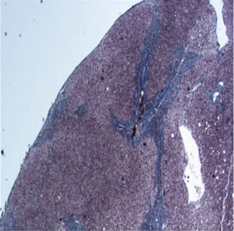 Histology Of Ectopic Liver In The Heart A Photomicrograph With