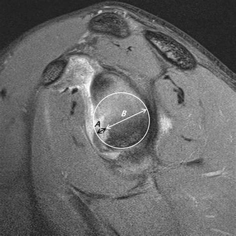 Measurement Of Glenoid Bone Loss Using The Best Fit Circle Method In Download Scientific