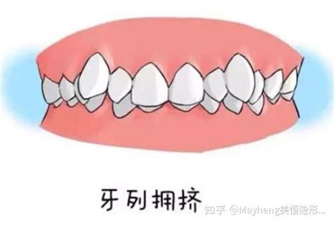 牙齿拥挤只能拔牙才能矫正？当然不是，推磨牙了解一下？ 知乎