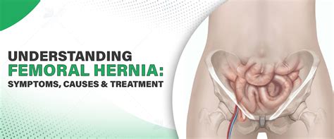 Understanding Femoral Hernia Symptoms Causes And Treatment In Noida