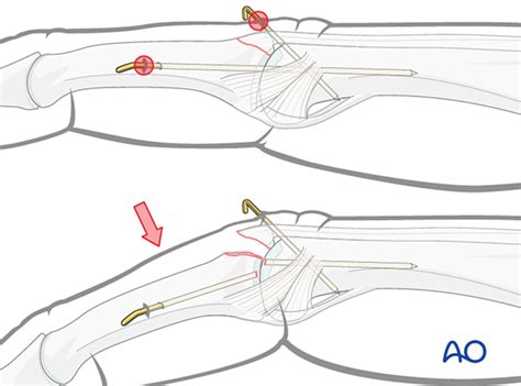 Extensor Block Pinning With Joint Transfixation For Dorsal Avulsion Of