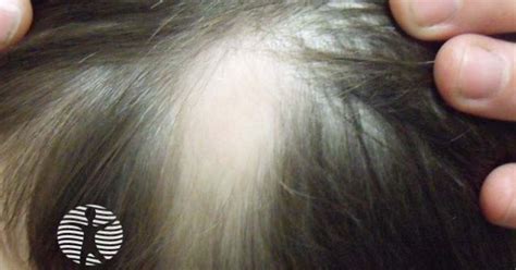 Triangular Temporal Alopecia Image