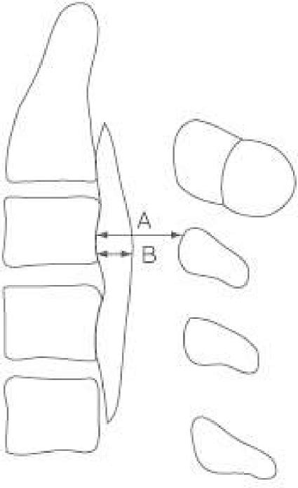 Classification Of Cervical Opll By Plain X Ray 1 Continuous Type 2