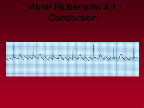 Ppt Approach To The Patient With Cadiac Arrhythmia Powerpoint