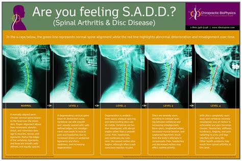 What Is Cervical Shock Mapametawan