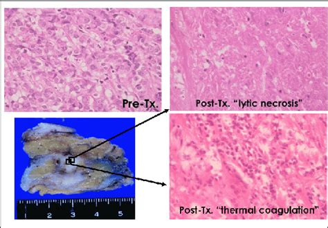 Pathological Study Reveals Cancer Necrosis Download Scientific Diagram