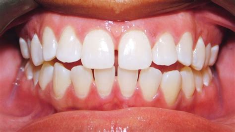 Class I Malocclusion Anterior Open Bite Dental Spacing Case Gallery