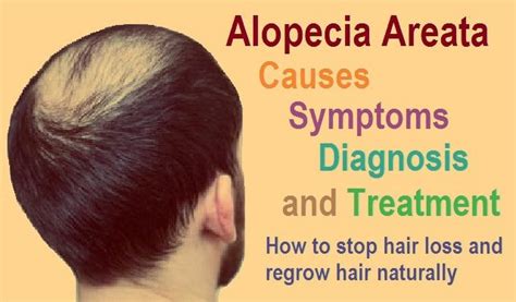 Everything You Need To Know About Alopecia Areata The Healthcare Daily