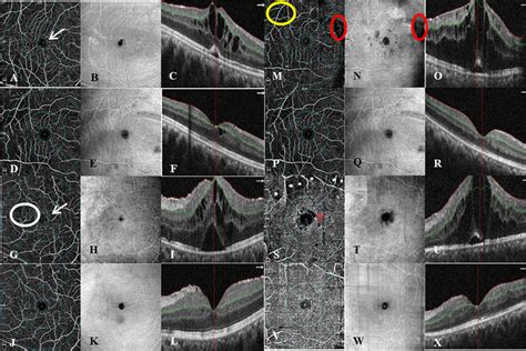 Baseline And Post Remission Octa And Structural Oct Of A Number Of The Download Scientific