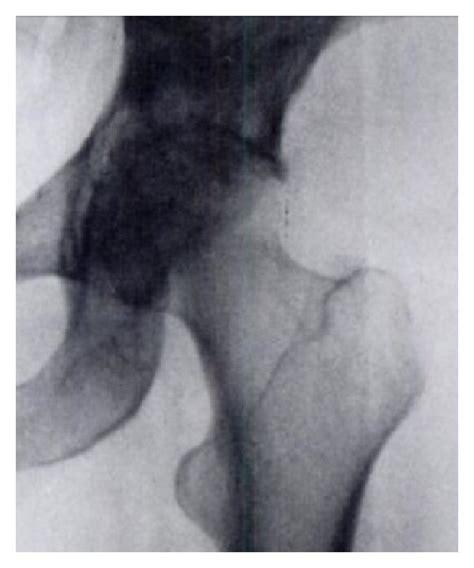 Classification Of Acetabular Defects According To Harrington A Download Scientific Diagram