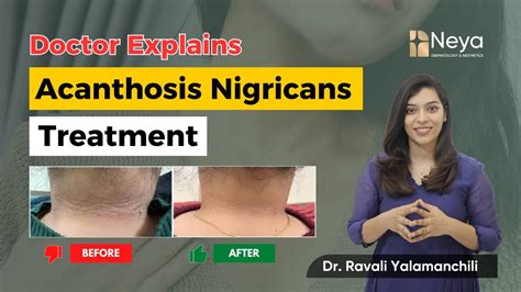 Acanthosis Nigricans Treatment Before And After By Dermatologist Dr