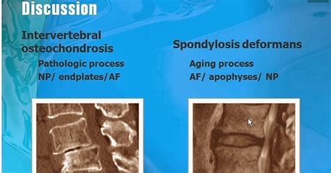 Musculoskeletal Intervertebral Osteochondrosis Vs Spondylosis Deformans