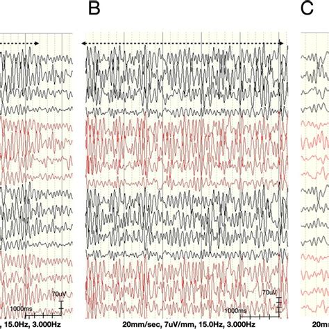 Sleep EEG Of Patient At And Y Of Age AC With A Montage Of Download Scientific