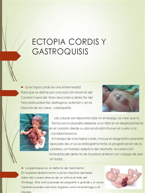 Ectopia Cordis Y Gastroquisis Pdf