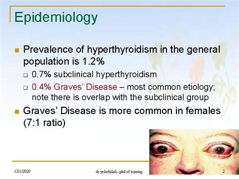 Graves Disease Epidemiology N Prevalence Of Hyperthyroidism In