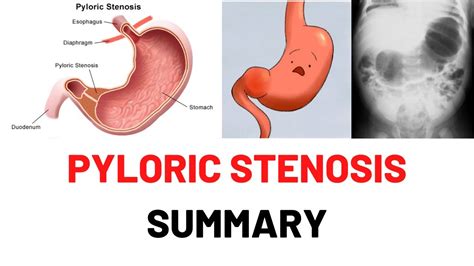Pyloric Stenosis Symptoms