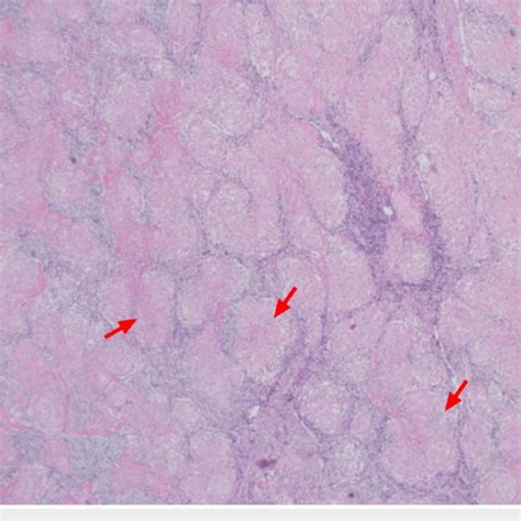 Multiple Non Caseating Granulomas From The Inguinal Lymph Node Red