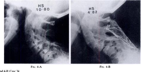 Figure 4 From Rheumatoid Arthritis Of The Cervical Spine Semantic Scholar