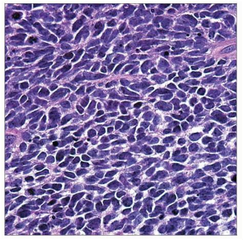 Cns Primitive Neuroectodermal Tumors Basicmedical Key
