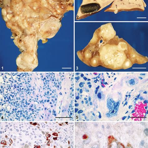 Pdf Non Gestational Malignant Placental Site Trophoblastic Tumor Of