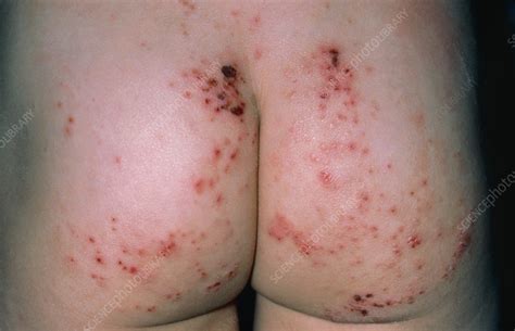 Infected Eczema On Buttocks Stock Image M1500141 Science Photo Library