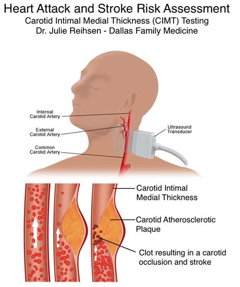 Cimt Testing The Best Cardiac Screening Test Available Pappas