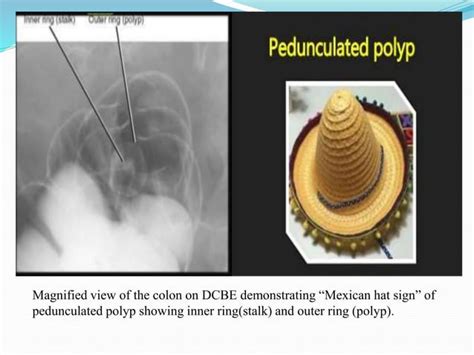 Imaging Of Large Bowel Polyp Pptx Digestive Disorders Diseases And Conditions