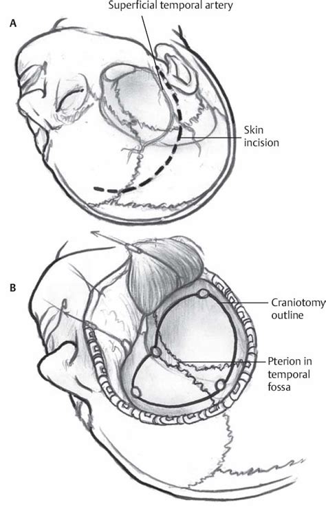 Pterional Approach Neupsy Key