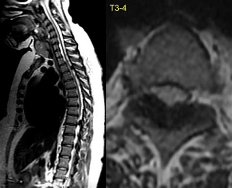 Ligamentum Flavum Cervical Spine