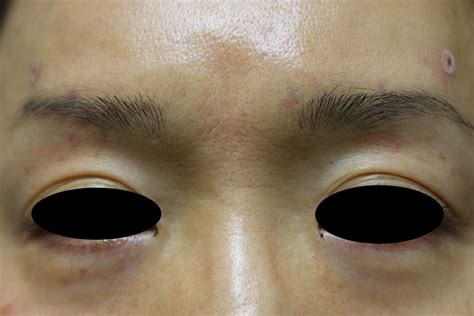 くぼみ目へのヒアルロン酸注入 美容のかかりつけ医を目指して