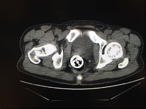 Procedural Sedation For The Removal Of A Rectal Foreign Body Jetem