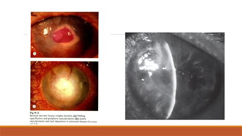 A Presentation On Infective Bacterial Keratitis Pptx Eye And Vision Conditions Diseases And