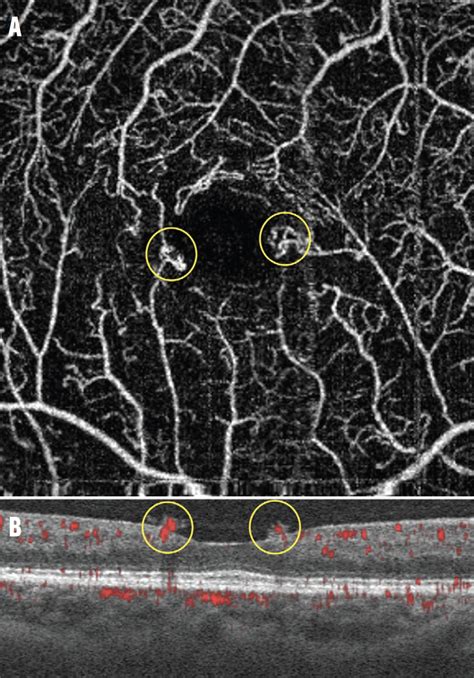 A Reference Guide For Oct Angiography Retina Today