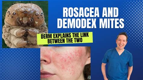 How To Kill Demodex Mites Treatments That Work 2024 Guide