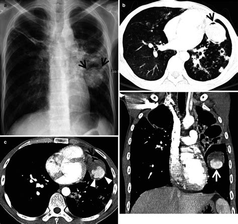 Air Crescent Sign Radiology Key
