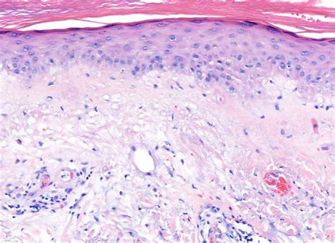 Pathology Outlines Atrophic Papulosis