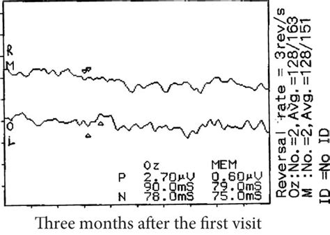Dark Adapted Single Flash Electroretinograms Erg And Pattern Visual