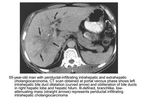 Diagnostic Imaging Of Cholangiocarcinoma Ppt Digestive Disorders